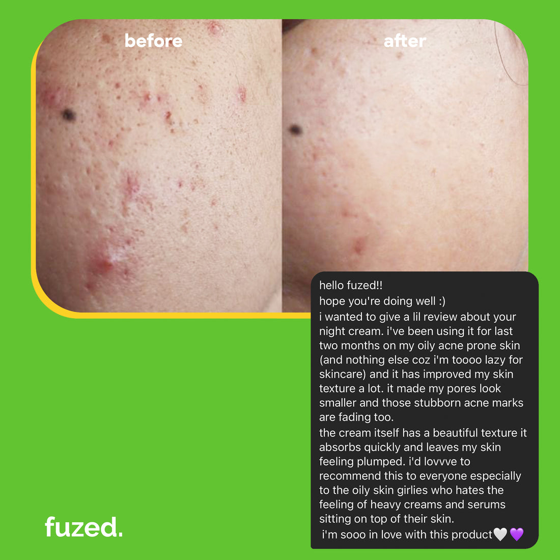 Best Moisturizer for Oily & Dry Skin | Fuzed